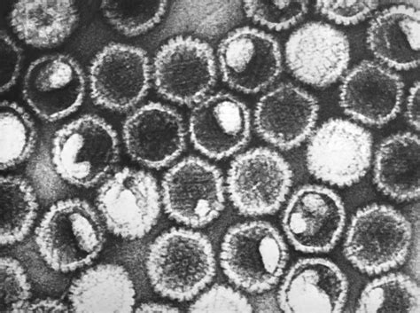 Oral Herpes Causes Signs Symptoms Diagnosis Treatment And Prognosis