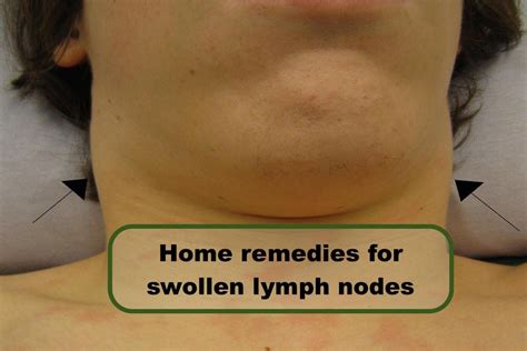 Enlarged Lymph Nodes