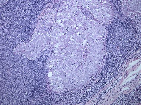 Light Microscope Image Of Lymph Node Infiltrated With Metastasis Of