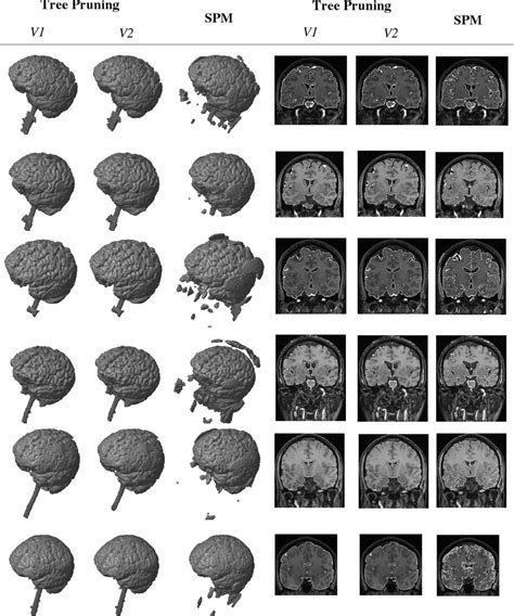 Brain Segmentation Results With Tree Pruning And Spm2 For 6 Of The 12 Download Scientific