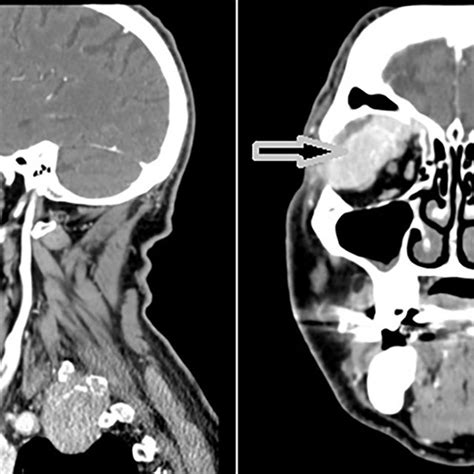 A Late Arterial Phase Of A Ct Scan The Figure Shows An Infiltrative