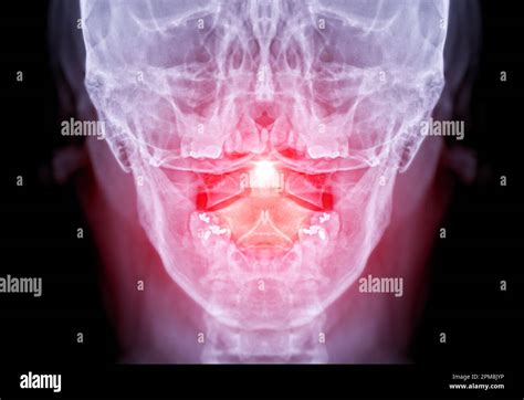 X Ray C Spine Or X Ray Image Of Cervical Spine Open Mount View For