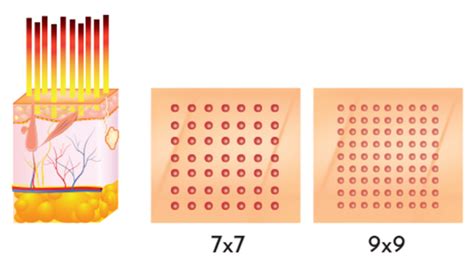 Erbium Yag Laser Skin Resurfacing • Hermosa Medspa Facial And Body