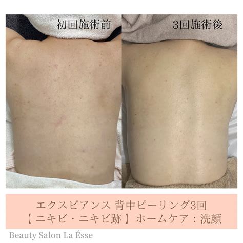 背中ニキビ対策 ハーブピーリング 3回分 その他