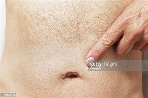 Herniated Belly Button Surgery