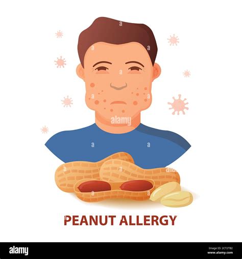 Nut Allergy Symptoms Problem Swollen Man Characteranaphylaxis Person