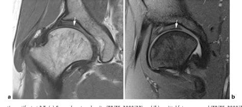 Figure 7 From Imaging Of Chondral Lesions Including Femoroacetabular
