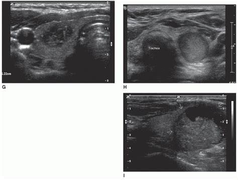 Fig 22 Simple Diffuse Goiter A Transverse Ultrasound