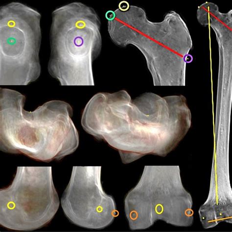 Femoral Torsion Measurement In A Craniocaudal View The Contour Of The
