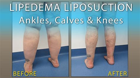 Lipedema Leg Surgery Lipo 360 Ankles Calves And Knees Liposuction