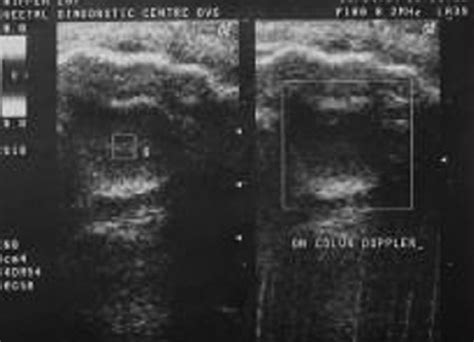 Ultrasonograph Showing Well Defined Anechoic Lesion Download