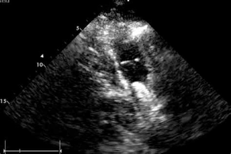 Tte View Of Our 4th Patient Showing Migration Of The Amplatzer Occluder