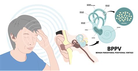 Benign Paroxysmal Positional Vertigo Bppv Tanya Doc