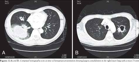Figure 1 From Urothelial Bladder Cancer With Cavitary Lung Metastases