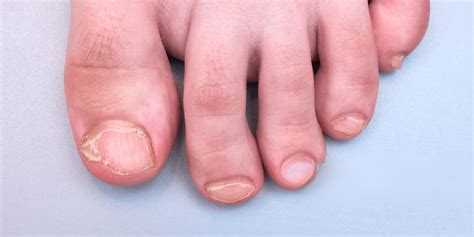 From Split To Brittle Effective Solutions For Treating Toenail