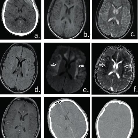 Radiologic Features With Severe Brain Involvement Download