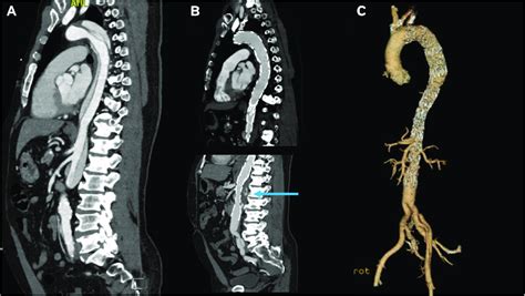 A Computed Tomography Angiography Cta Indicating Type B Aortic