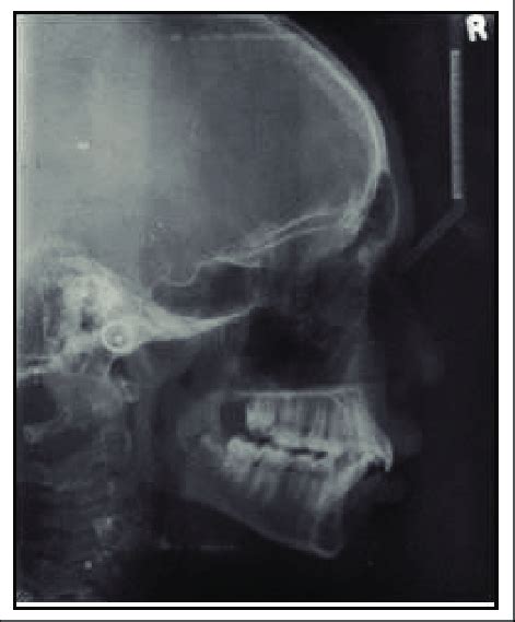Pretreatment Lateral Cephalogram Download Scientific Diagram