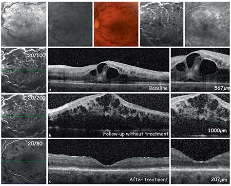 Well Perfused Central Vein Occlusion With Macular Cystoid Edema Before
