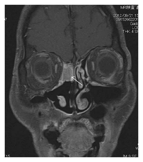 Preoperative Local Finding And Mri In Case 2 A Tumor In The Right