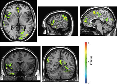 Nature Experience Reduces Rumination And Subgenual Prefrontal Cortex Activation Elena
