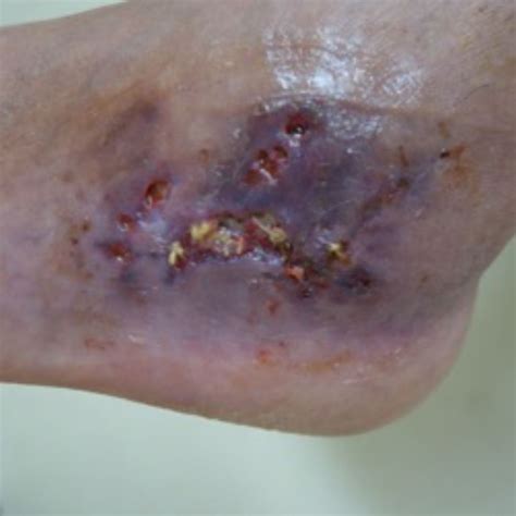 Infection Mimicking Skin Condition Pyoderma Gangrenosum Bmj Case Reports