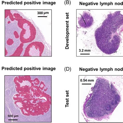 Representative Examples Of The Delineation Of Metastatic Lesions By The Download Scientific