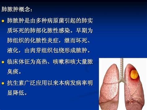 后悔：今日和大家分享一个病 —肺脓肿，没治好的一个病例 每日头条