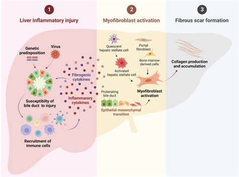 Liver Fibrogenesis In Ba The Fibrogenic Cascade In Ba Liver Can Be