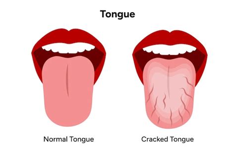 Premium Vector Cracked Tongue Problem In Human
