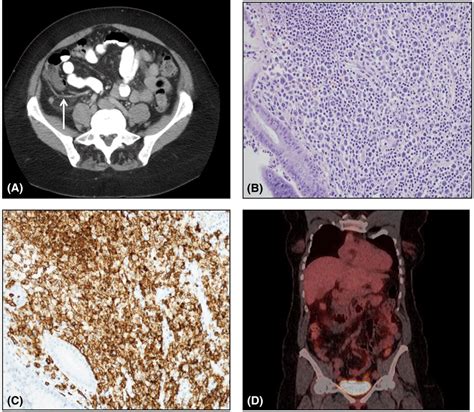 A Ct Scan Showing Dilated Appendix With Nonspecific Periappendiceal