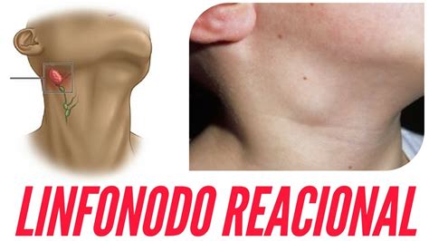 O Que é Linfonodo Reacional Dr Jônatas Catunda Youtube