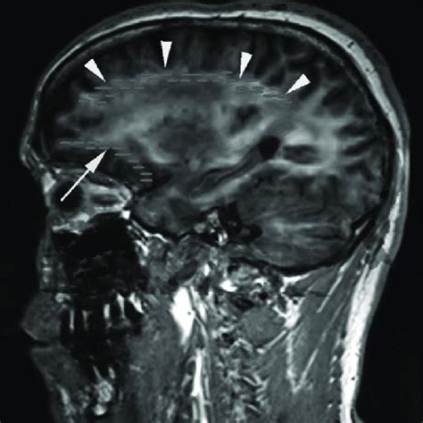 The Tract Superior Longitudinal Fasciculus Yellow Arrowhead An