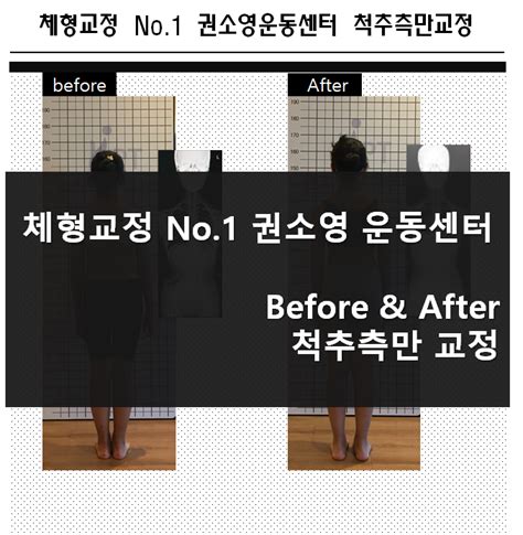 마린시티 피티 Pt 부산 해운대 센텀 퍼스널트레이닝 체형교정 초등학생 척추측만 슈로스운동 Before And After 네이버 블로그