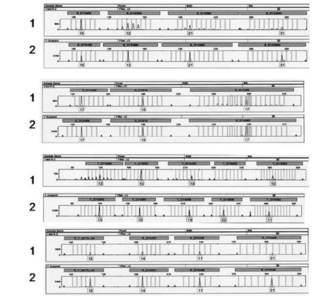 dna typing of y chromosome str loci 1 sm positive stain sample 2