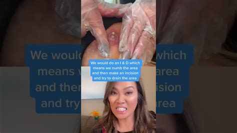 Dr Pimple Popper Reacts To Inflamed Cyst Shorts Drpimplepopper Youtube