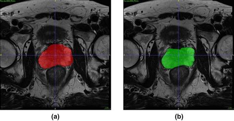 An Example Of The Evident Segmentation Variability In The Masks Drawn Download Scientific