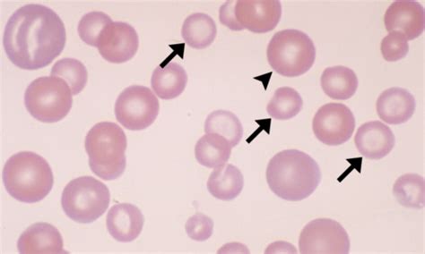 Blood Cell Anomalies Flashcards Quizlet