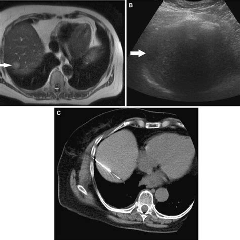 70 Year Old Female With A History Of Breast Cancer And An Indeterminate
