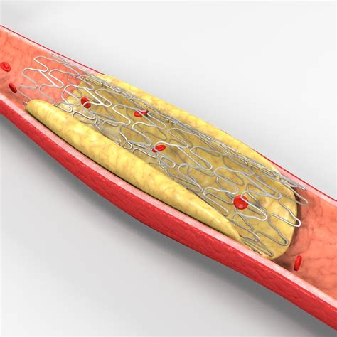 Medical Cardiovascular Stent 3d Model