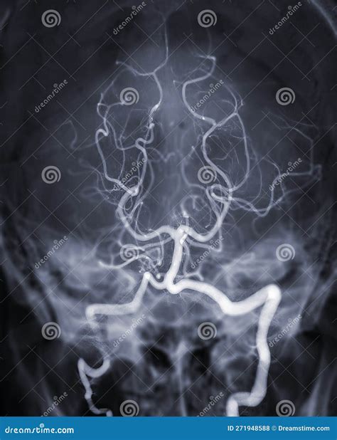 Cerebral Angiography Image From Fluoroscopy In Intervention Radiology