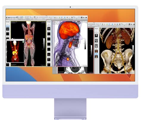 Osirix Md India Authorized Osirix Partners In India Delhi