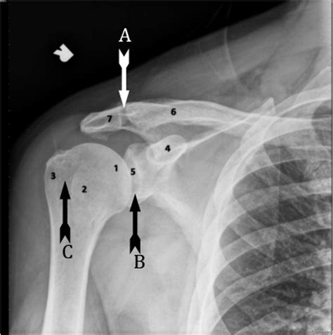 Shoulder X Ray Technique Chart At Abdul Grigsby Blog