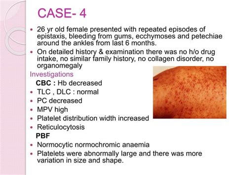 Investigation Of Purpuric Rash Ppt