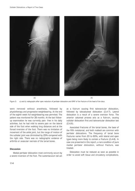 Subtalar Dislocation Pdf