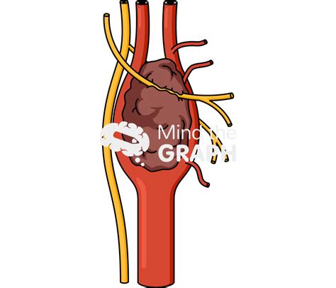Carotid Body Tumor Type 2