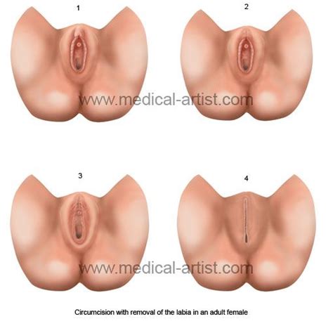 Circumcised Women Sex