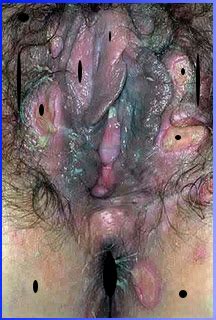 Blue Waffle Myth Sex Disease ~ Blue Waffles Disease Pictures