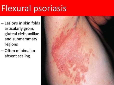 Stem Cell Therapy In Psoriasis Dr Sharda Jain Dr Jyoti Aggarwal