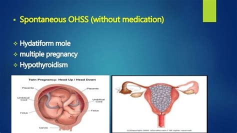 Ovarian Hyperstimulation Syndrome
